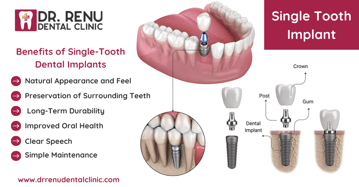 What are The Benefits of Single Tooth Dental Implants? - Renu Dental