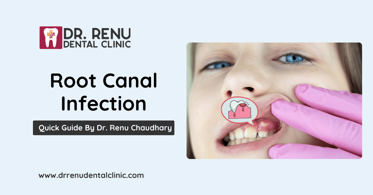 Knowing All About Root Canal Infection - Dr. Renu Dental Clinic