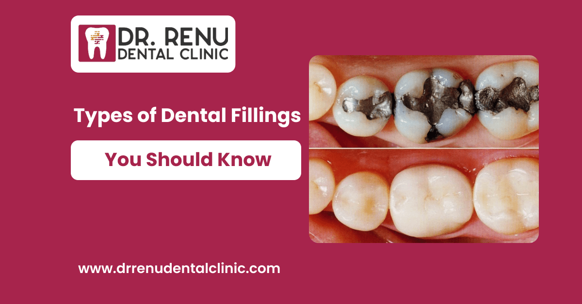 Types of Dental Fillings You Should Know - Renu Dental