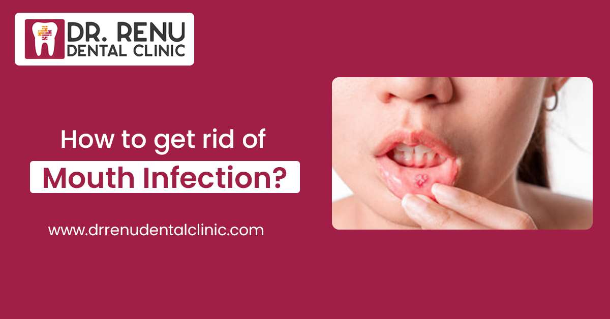 How to Get Rid of Mouth Infections – A Comprehensive Guide